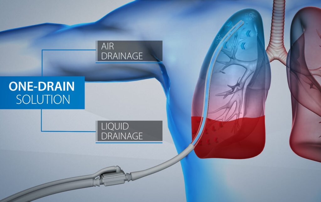 Round Coaxial Thoracic Drain (One Drain Solution) by Redax - Med ...